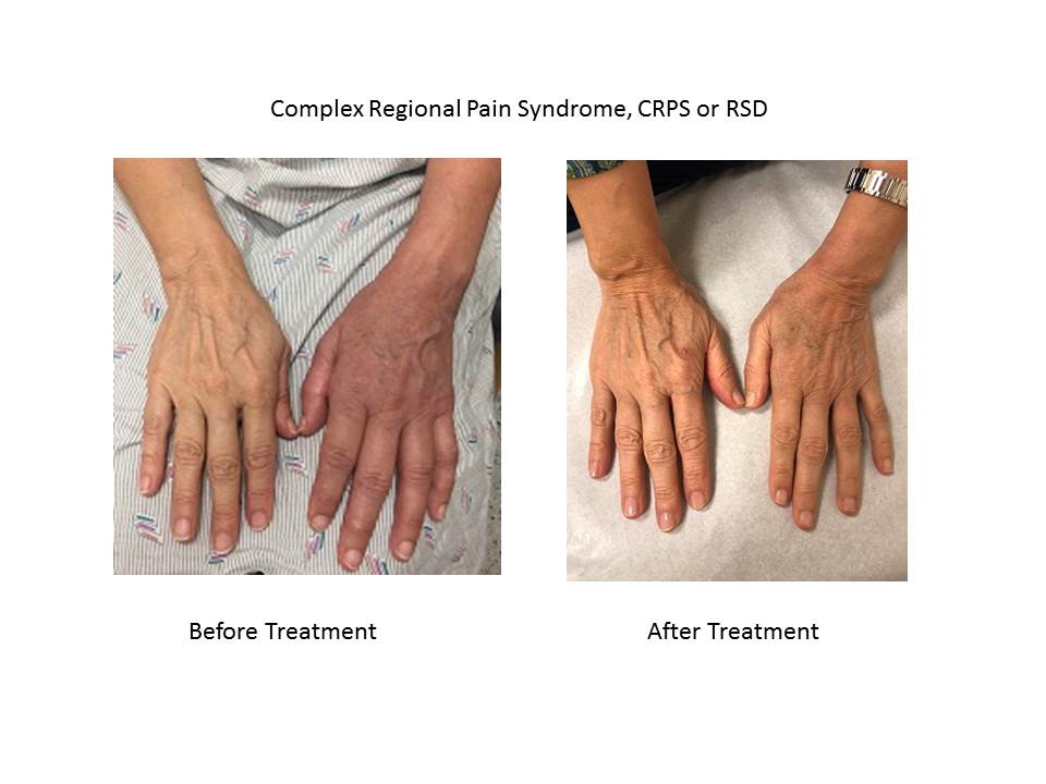 Reflex Sympathetic Dystrophy Rsd