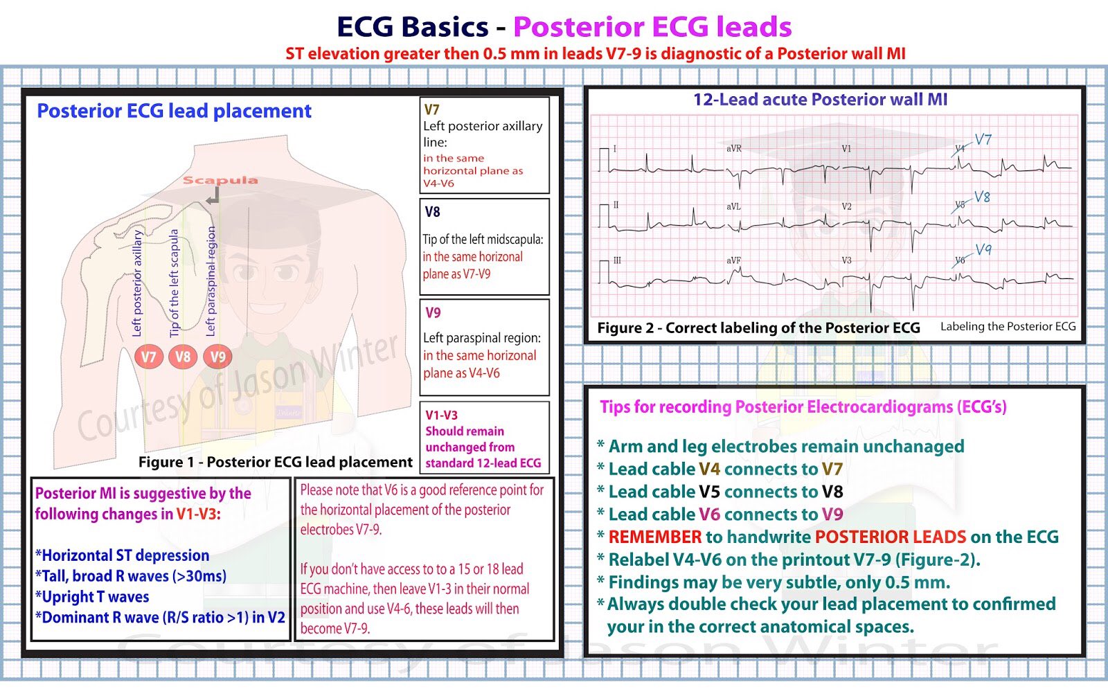 Normal 12 Lead Ecg Labeled