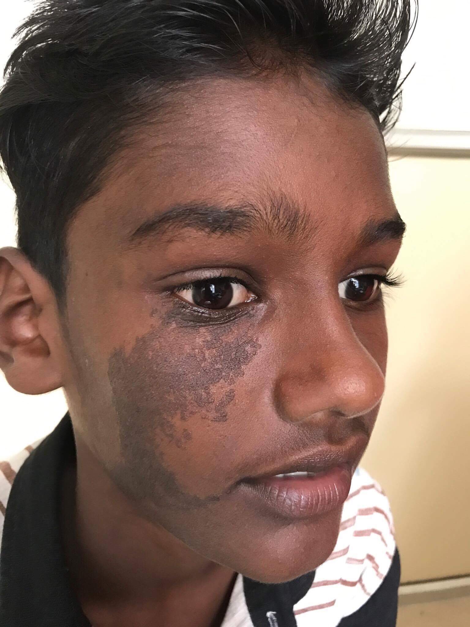 Epidermal Nevus Face