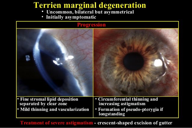 Marginal Corneal Degeneration