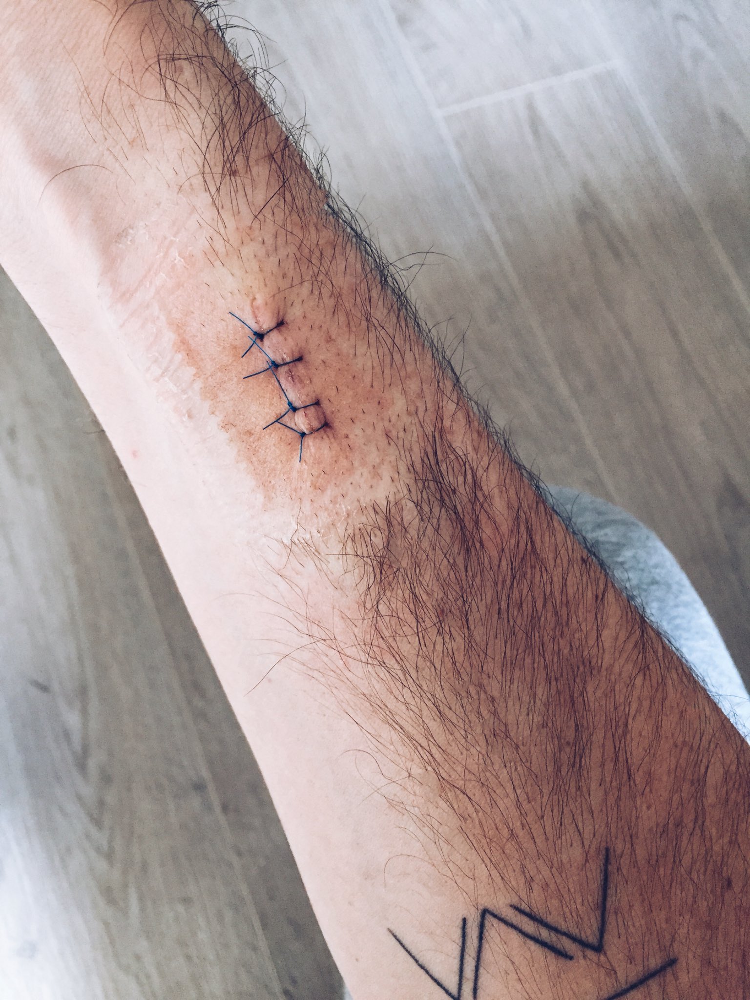Forearm Stitches