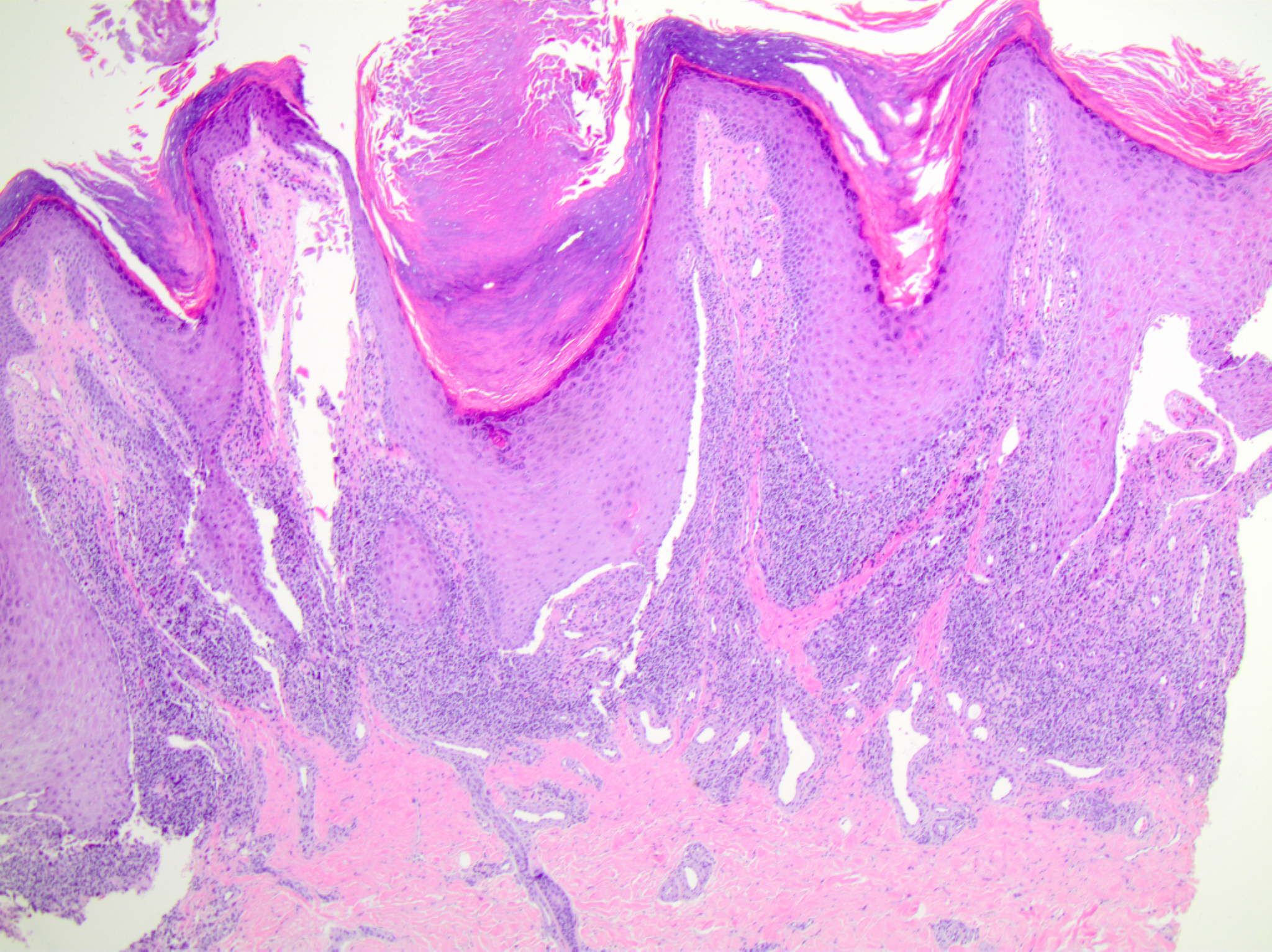 Hypertrophic Lichen Planus