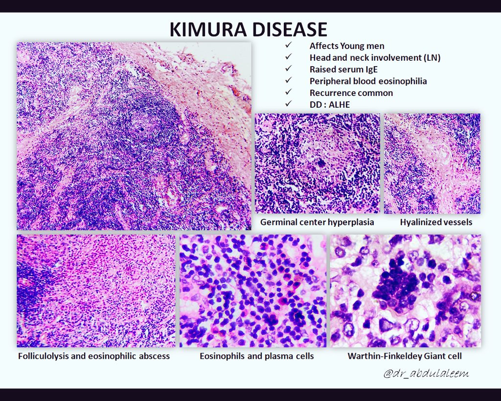 Kimuras Disease