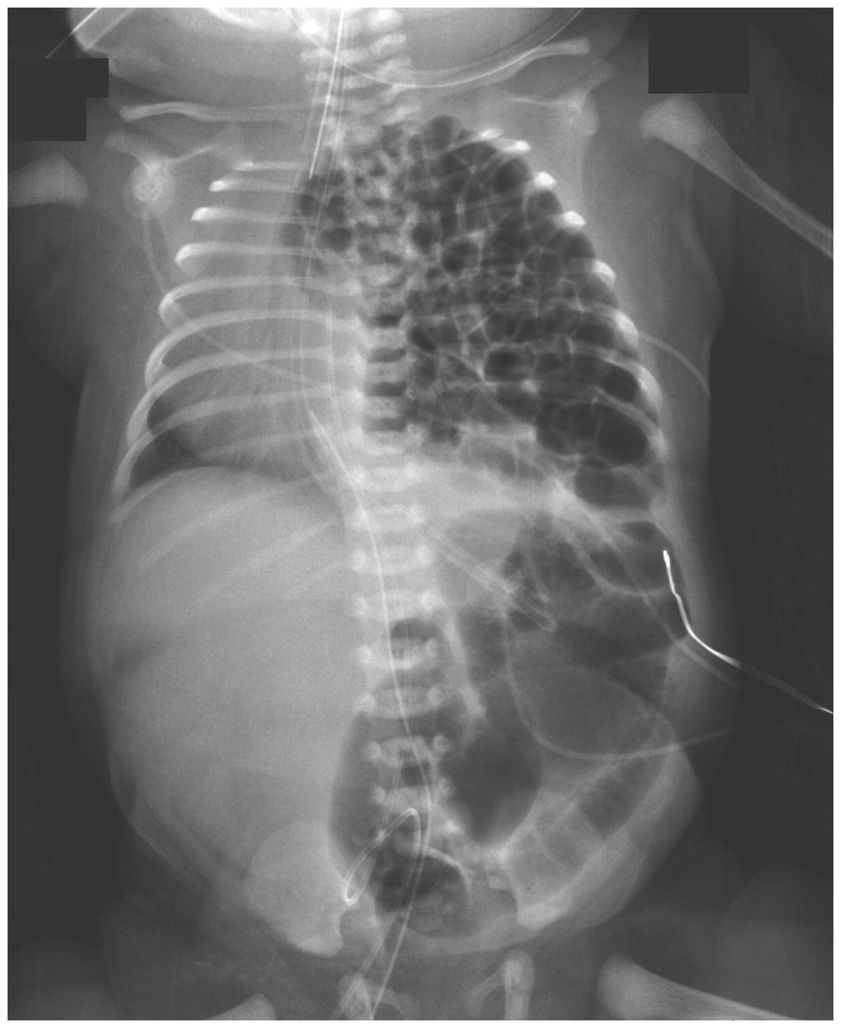 Diaphragmatic Hernia X Ray
