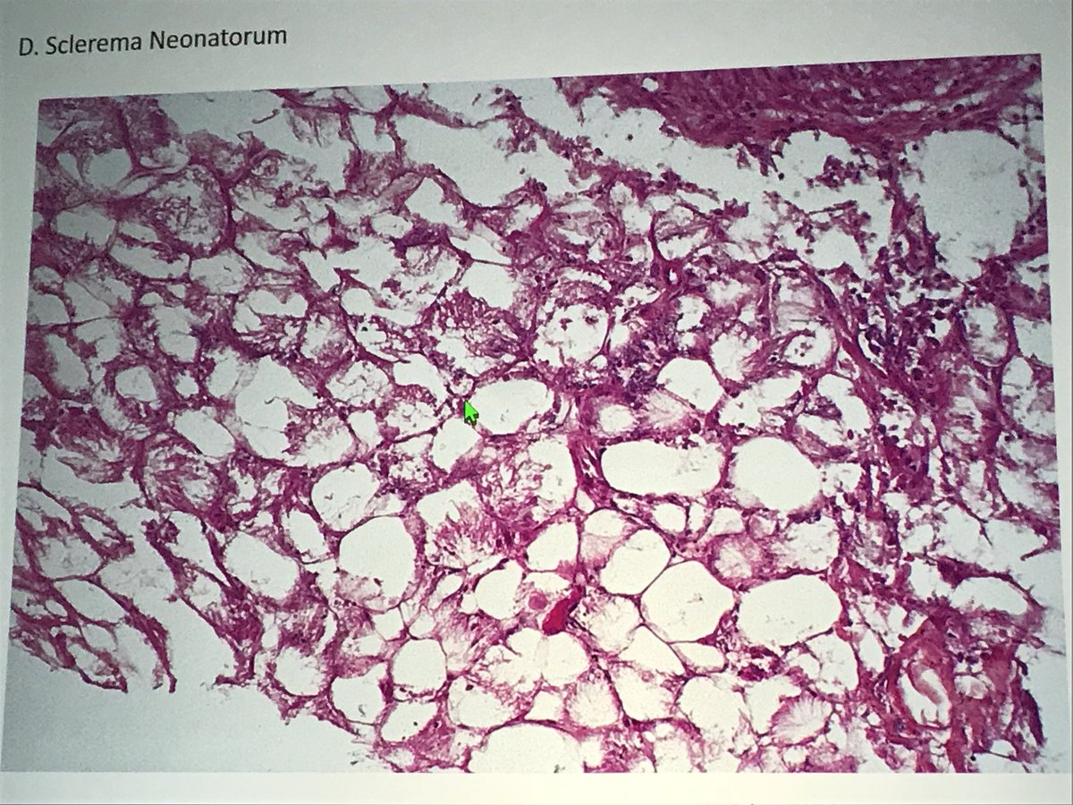 Sclerema Neonatorum
