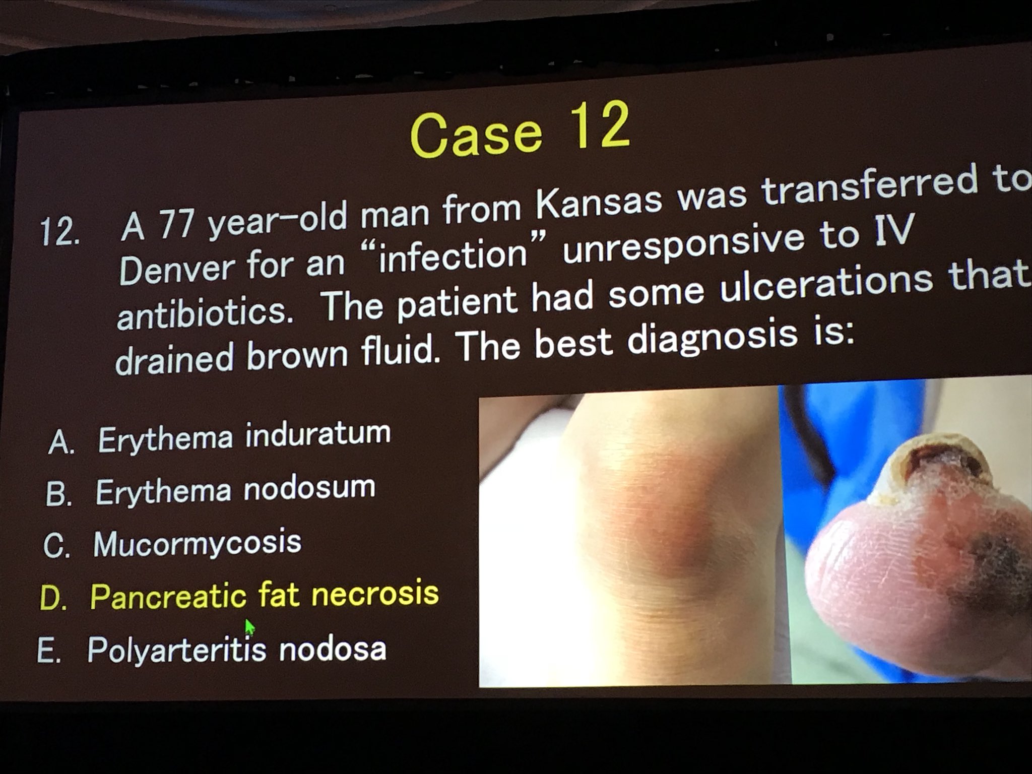 Fat Necrosis Pancreas