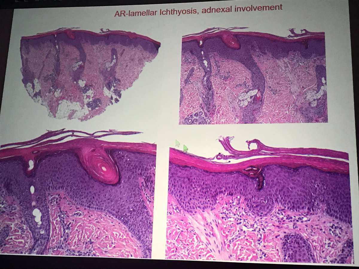 Lamellar Ichthyosis Histology