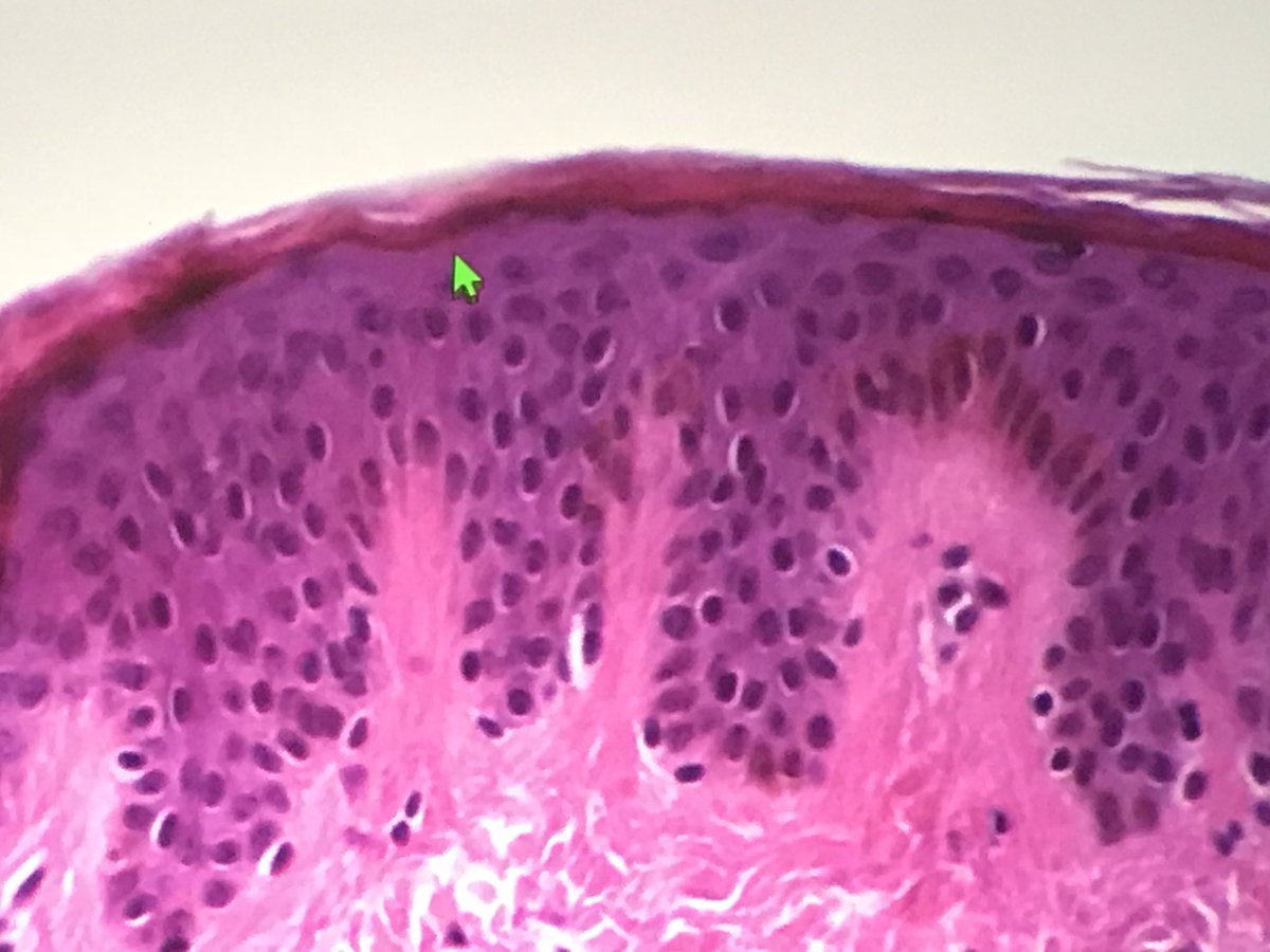 Ichthyosis Vulgaris Histology Acquired Ichthyosis With Systemic Lupus