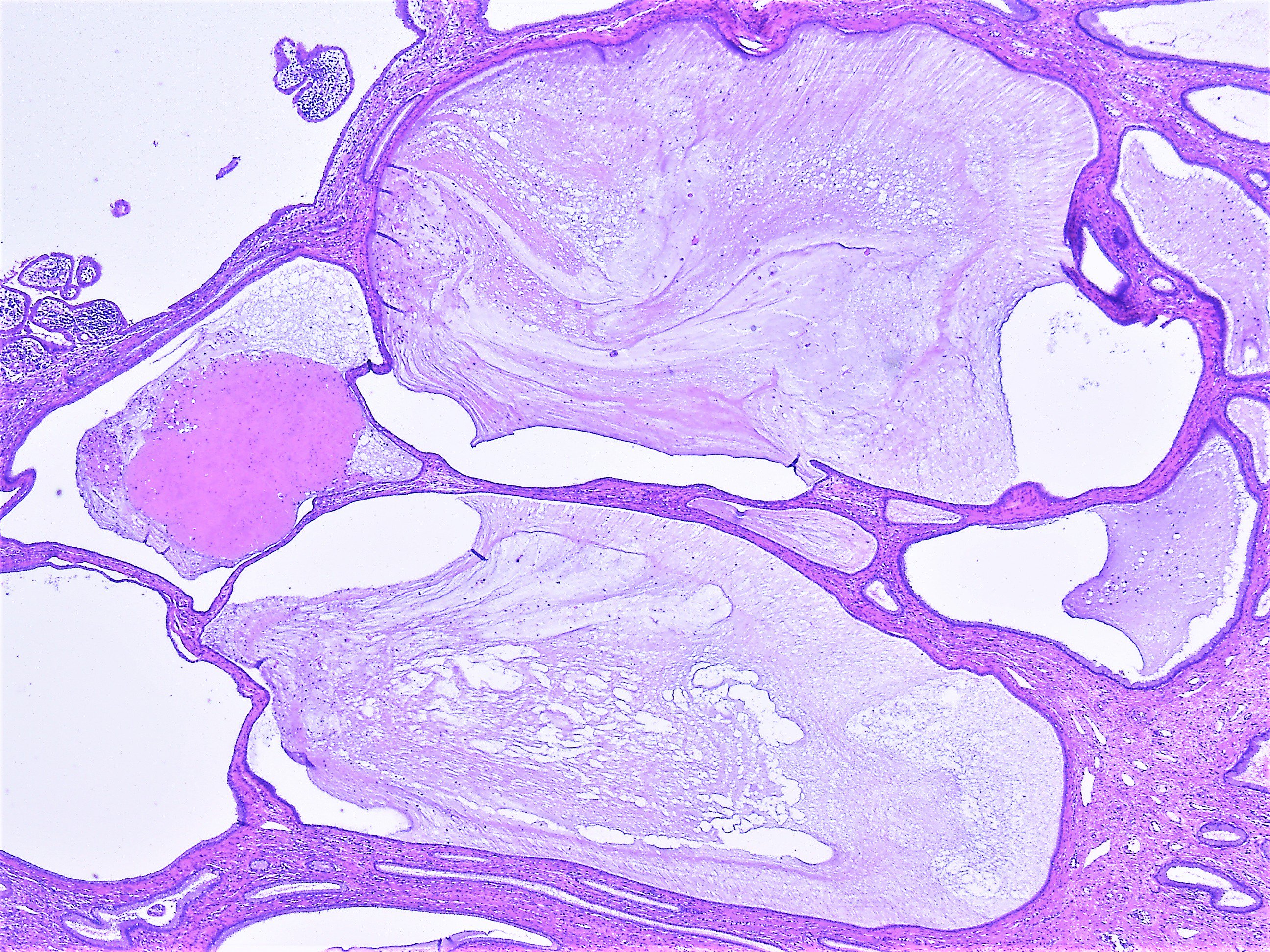 Pathology Walkerauto Tweet Bot On Twitter Nabothian Cyst Of Uterine Cervix Uterus