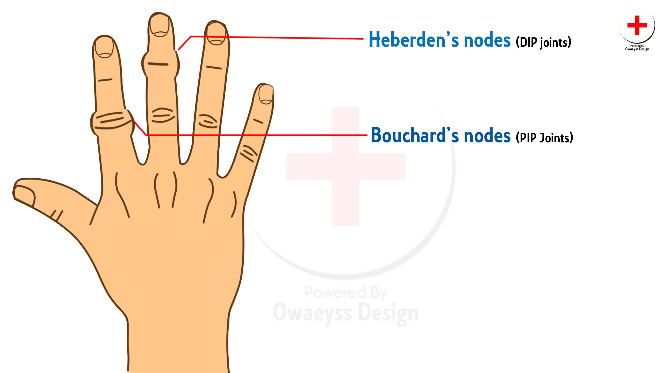 Heberdens Nodes