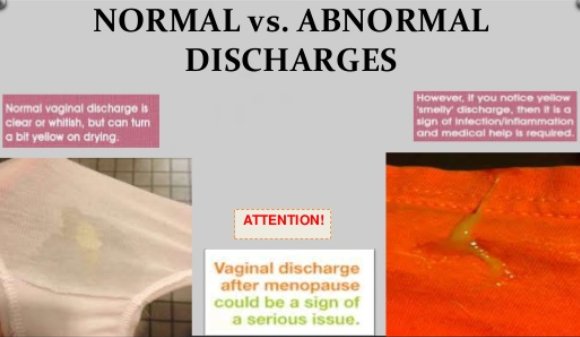 Vaginal Discharge Normal Vs Not Normal