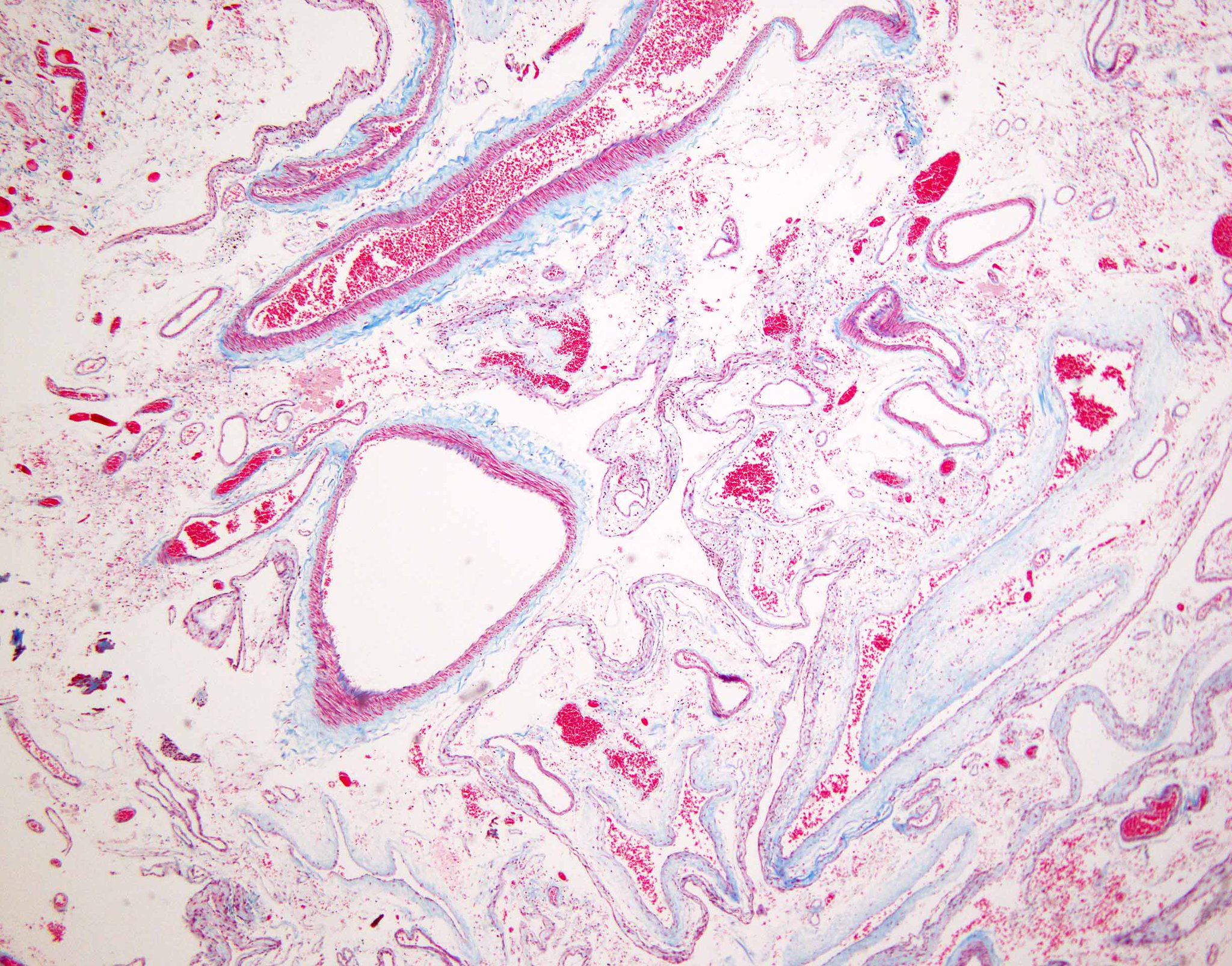 Arteriovenous Malformation Histology