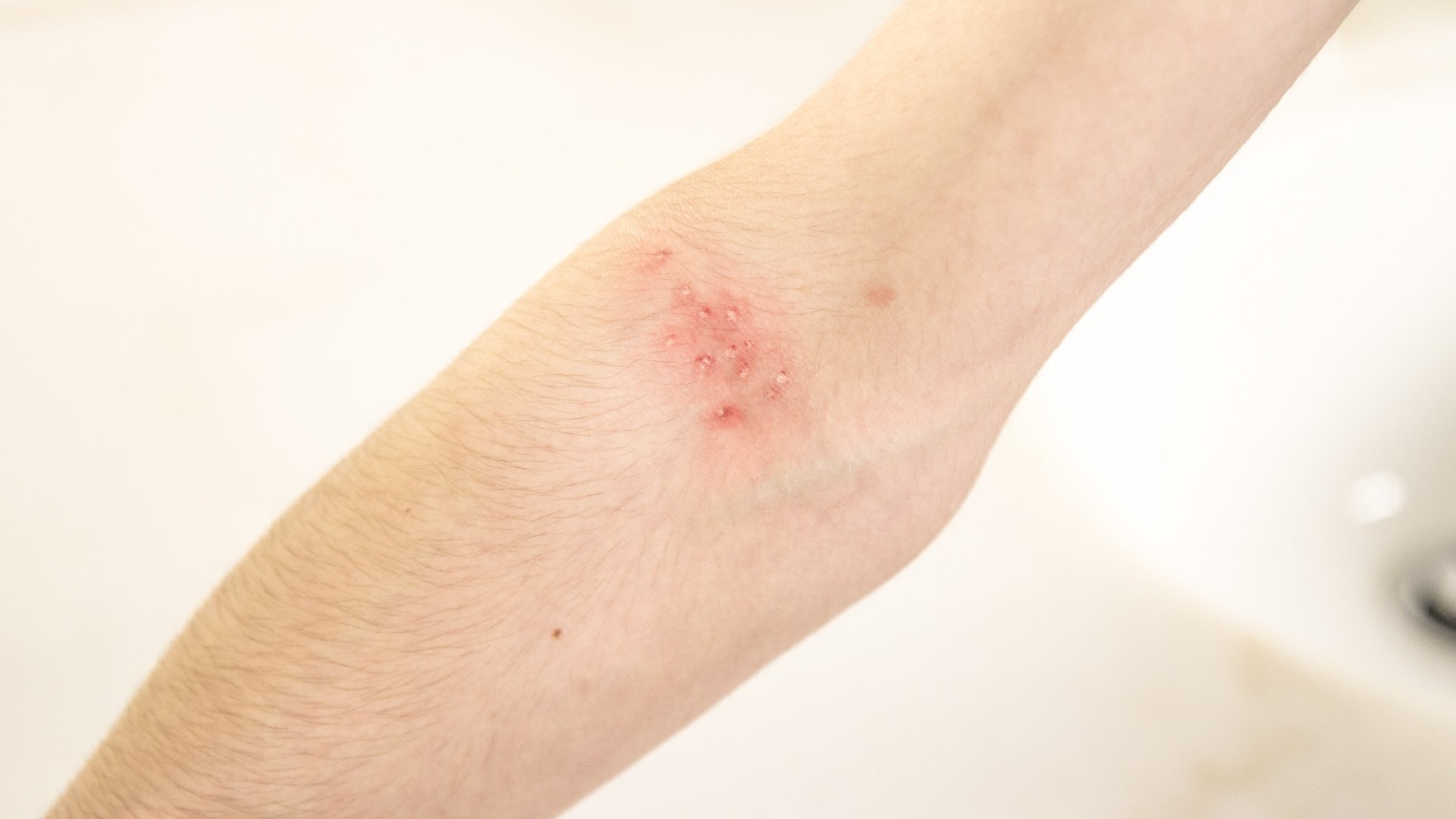 Scabies Bites On The Arm