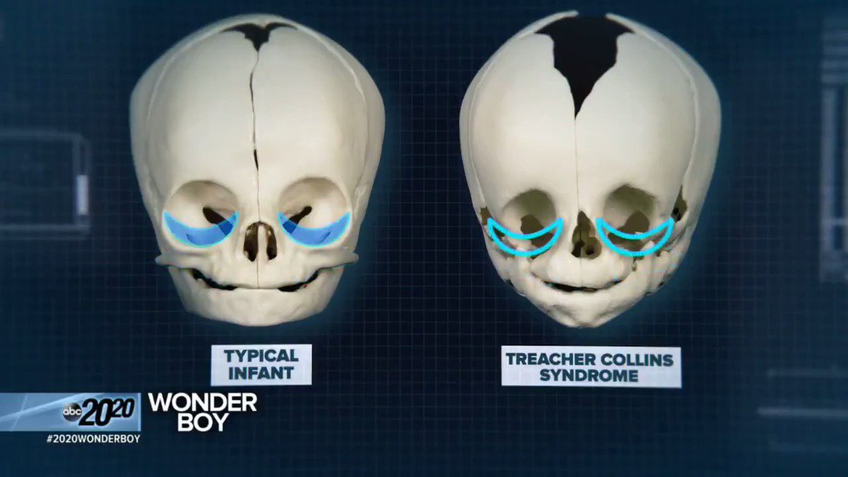 Treacher Collins Syndrome Skull