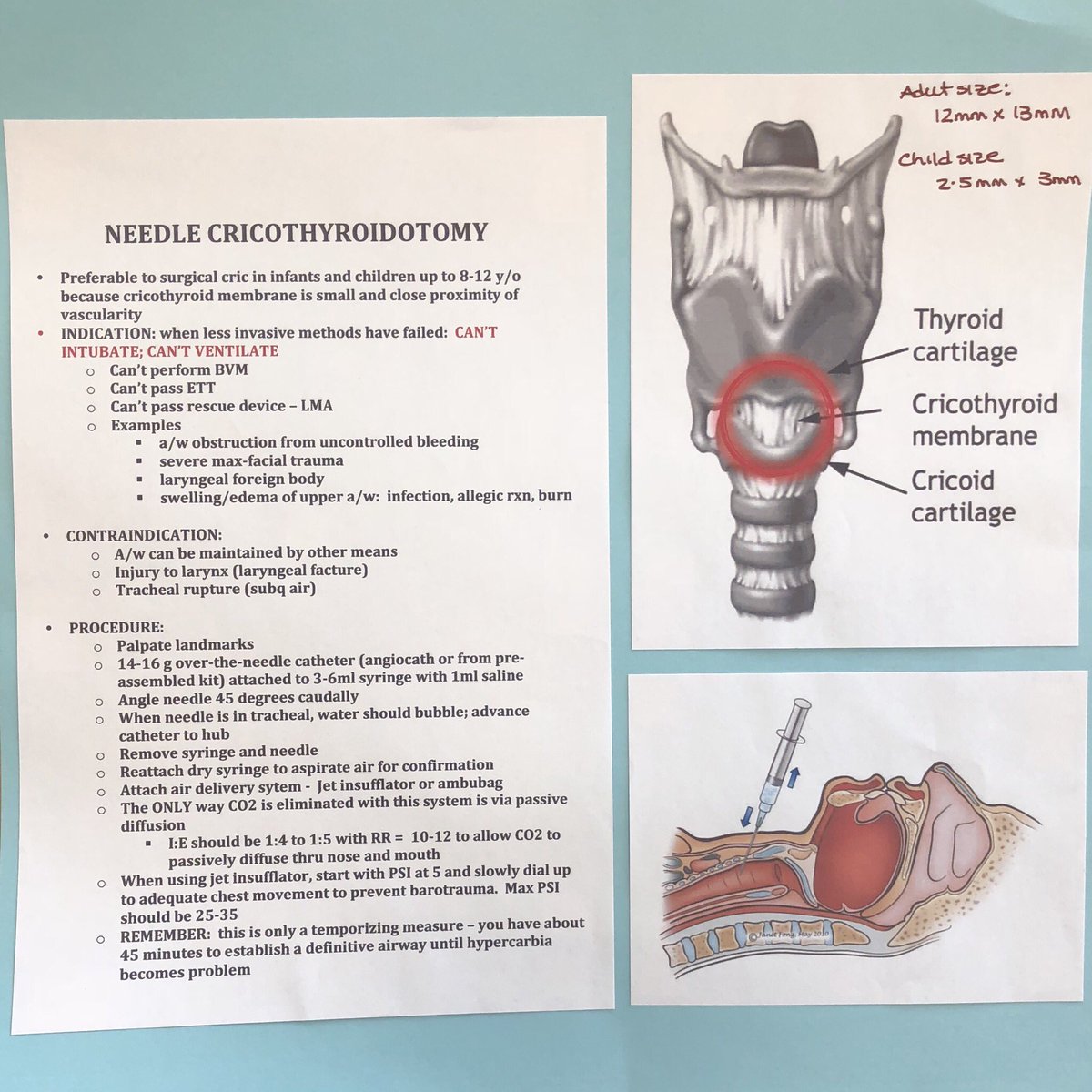 Cricothyroidotomy