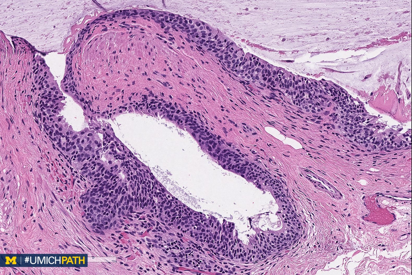 Urachal Cyst Histology