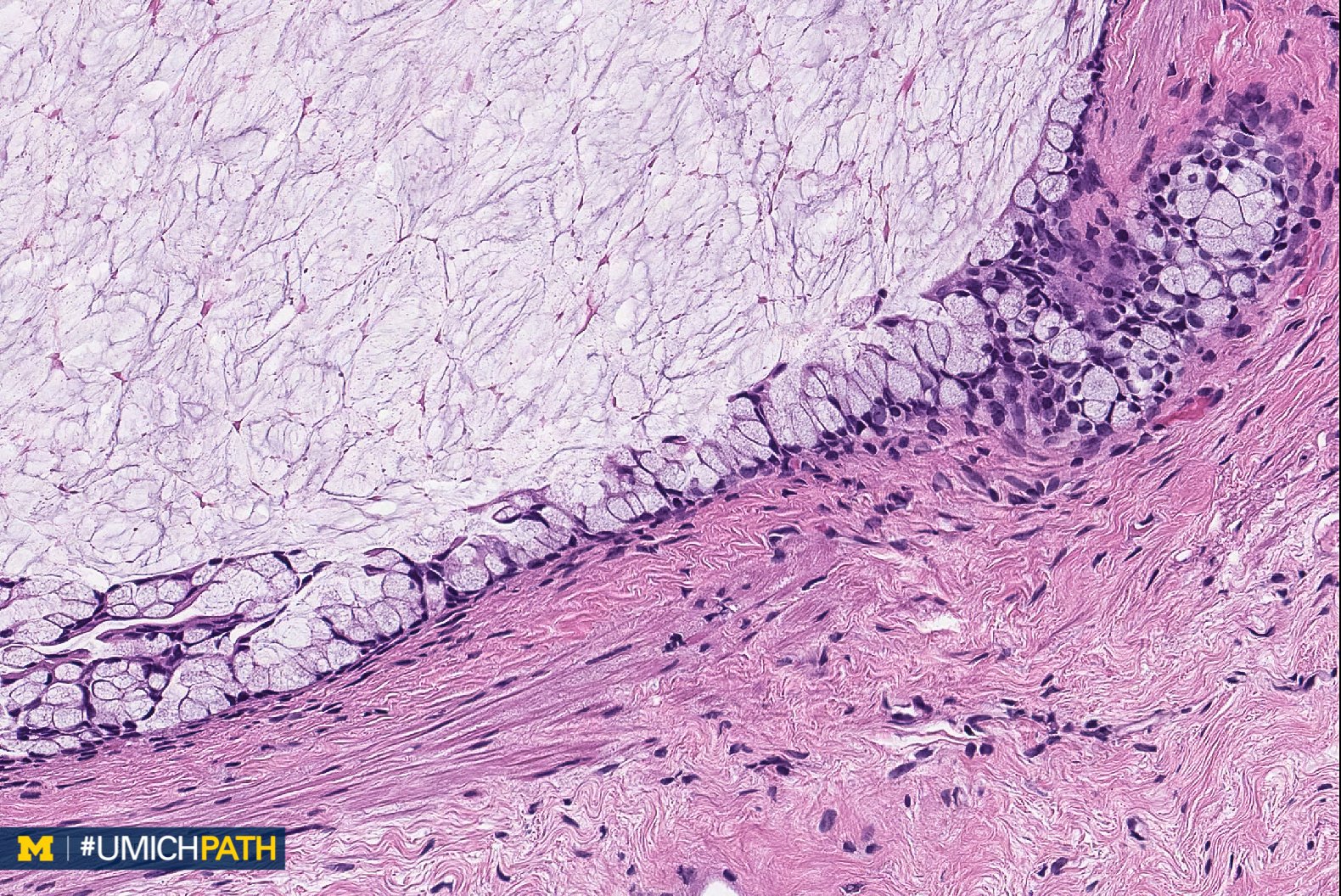 Urachal Cyst Histology