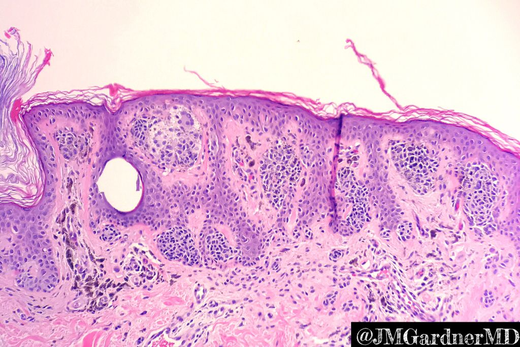 Compound Nevus Histology