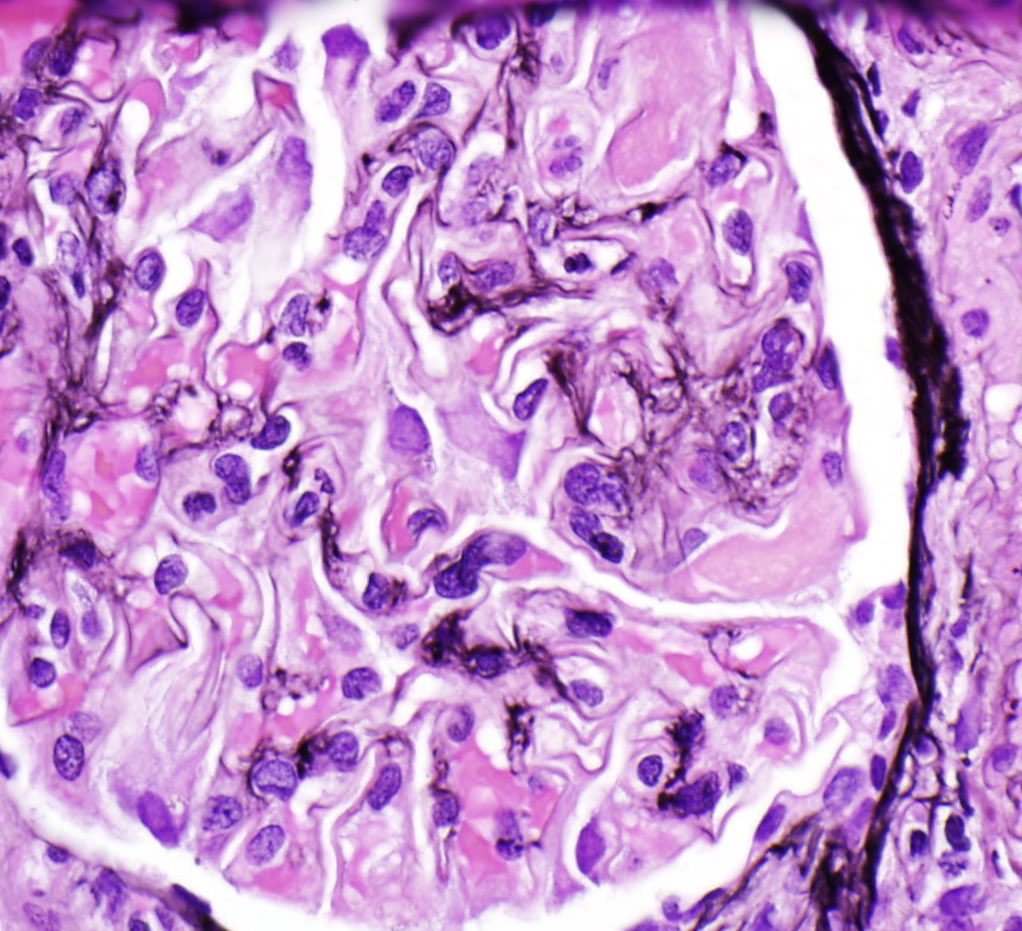 Venous Thrombosis Histology
