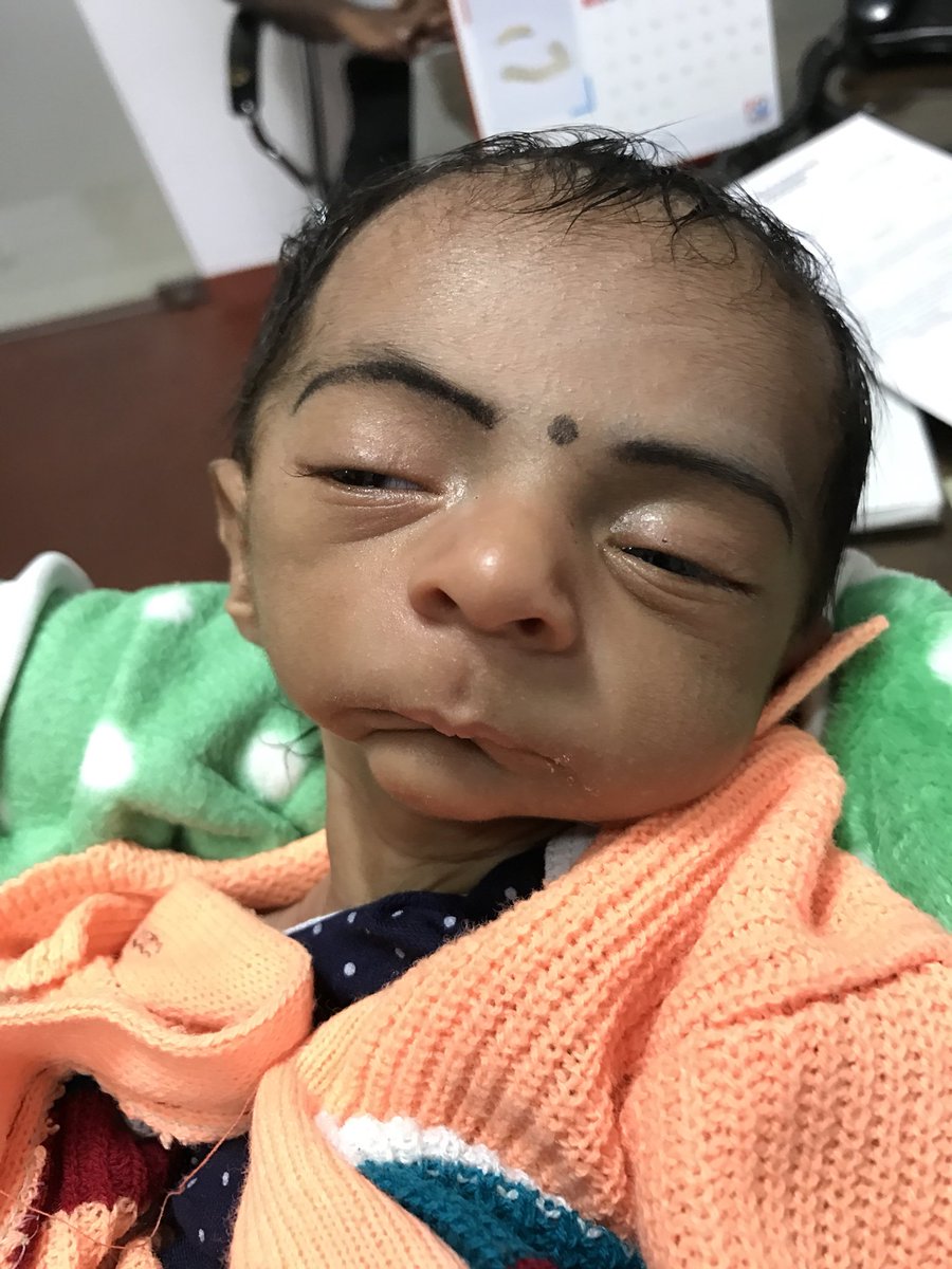 Mandibular Hypoplasia