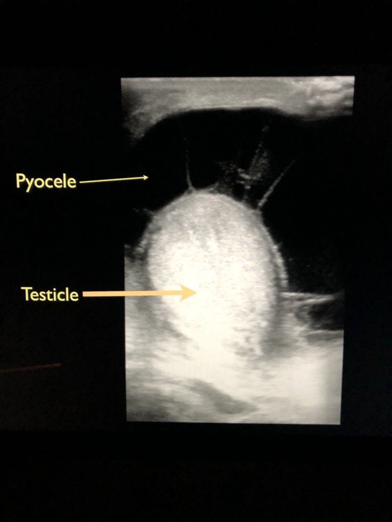 Pyocele Ultrasound