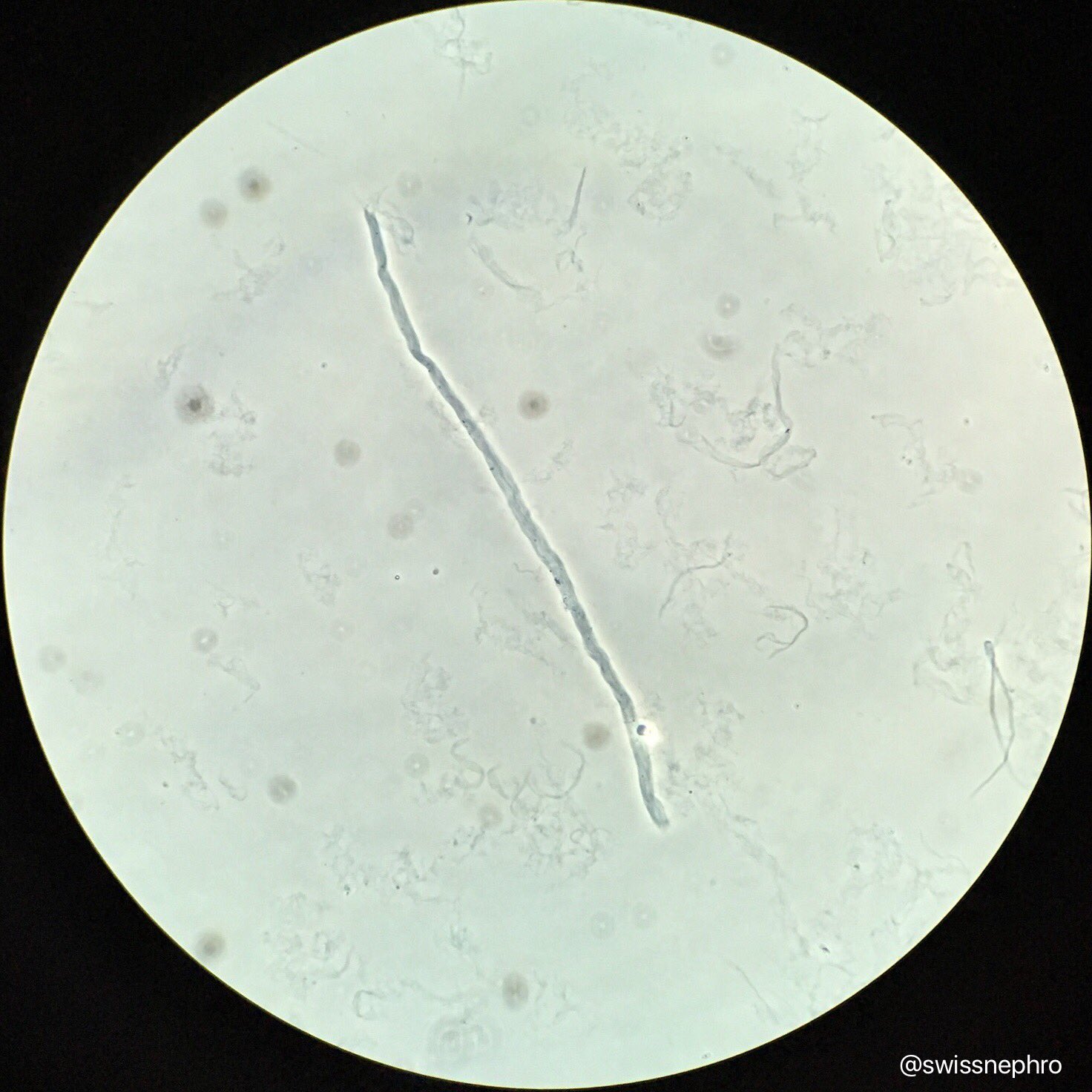 Mucus Threads In Urine Men