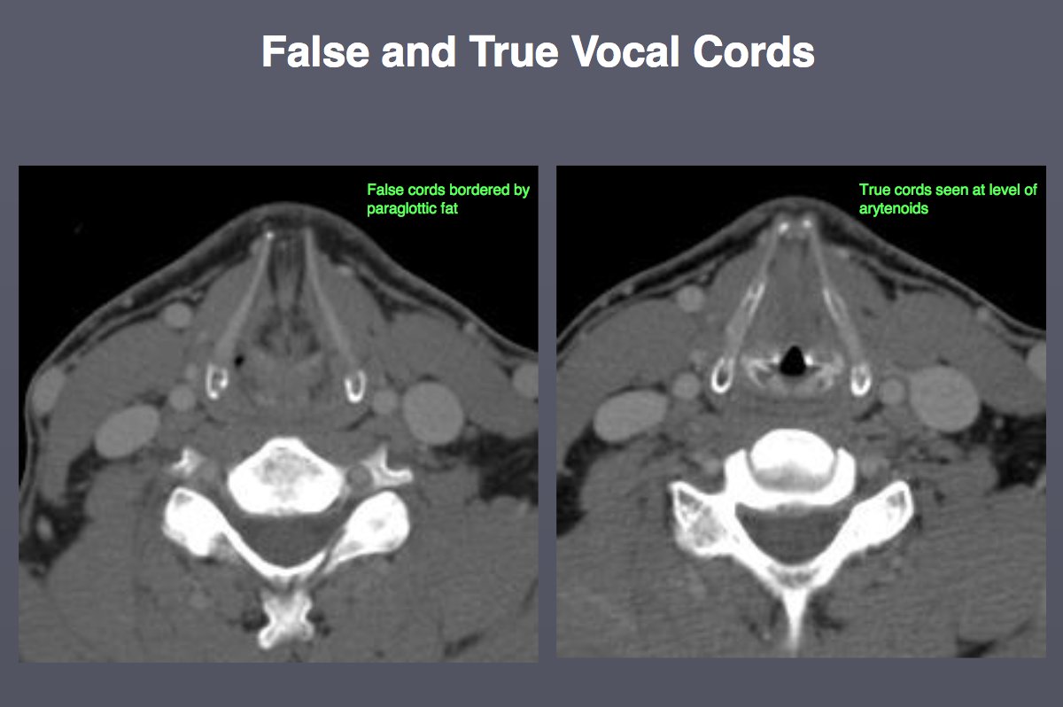True And False Vocal Cords