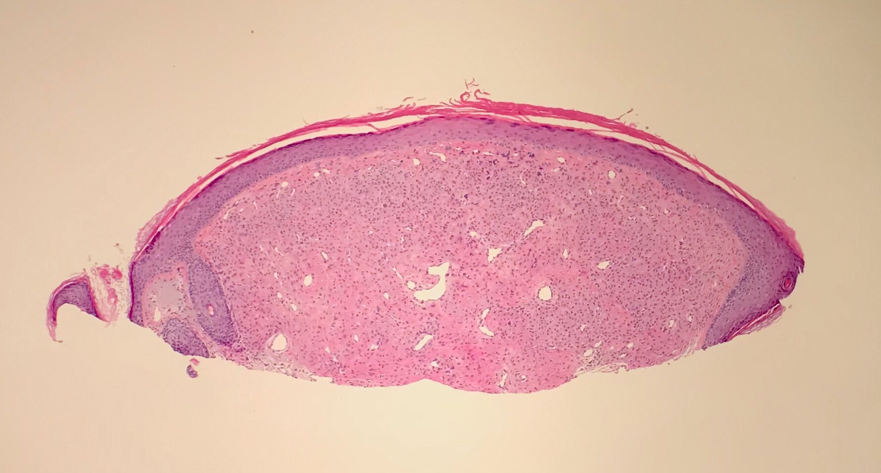 Fibrous Papule Histology