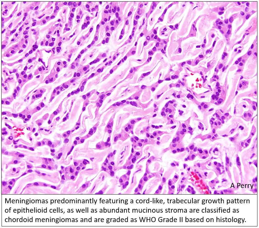 Meningioma Histology