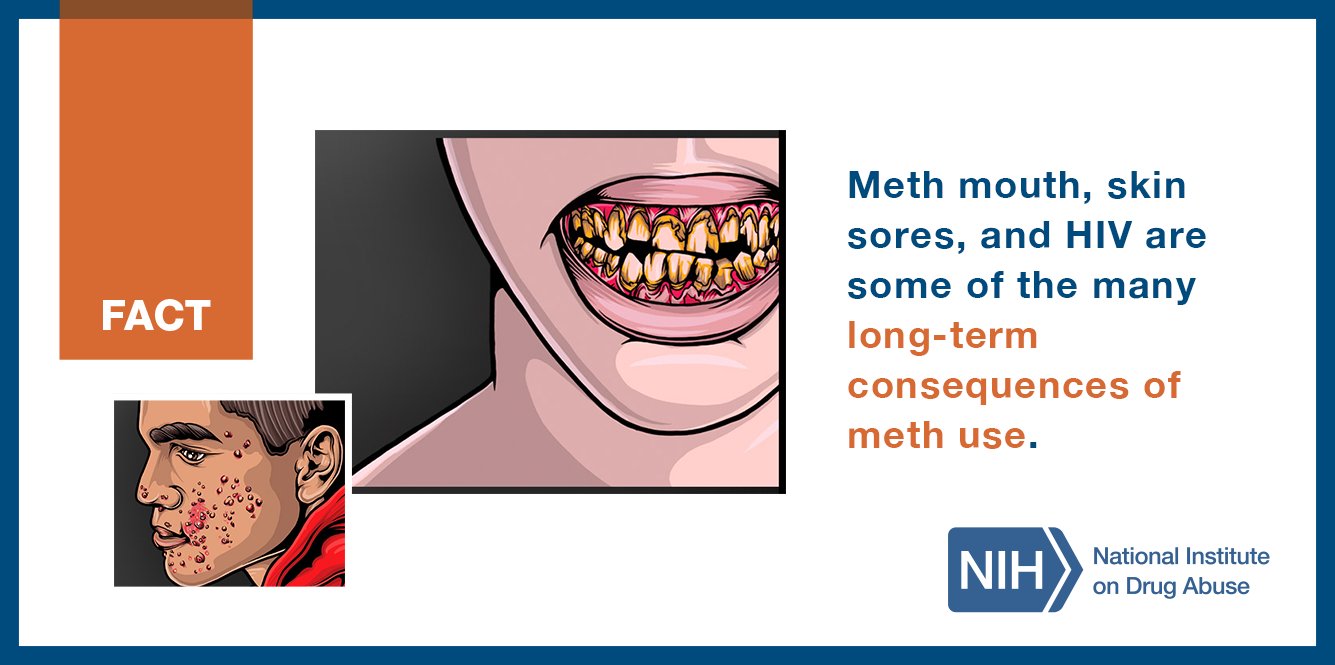 Meth Mouth