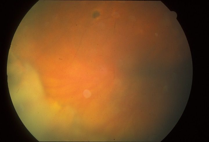 Intermediate Uveitis Snowbanking