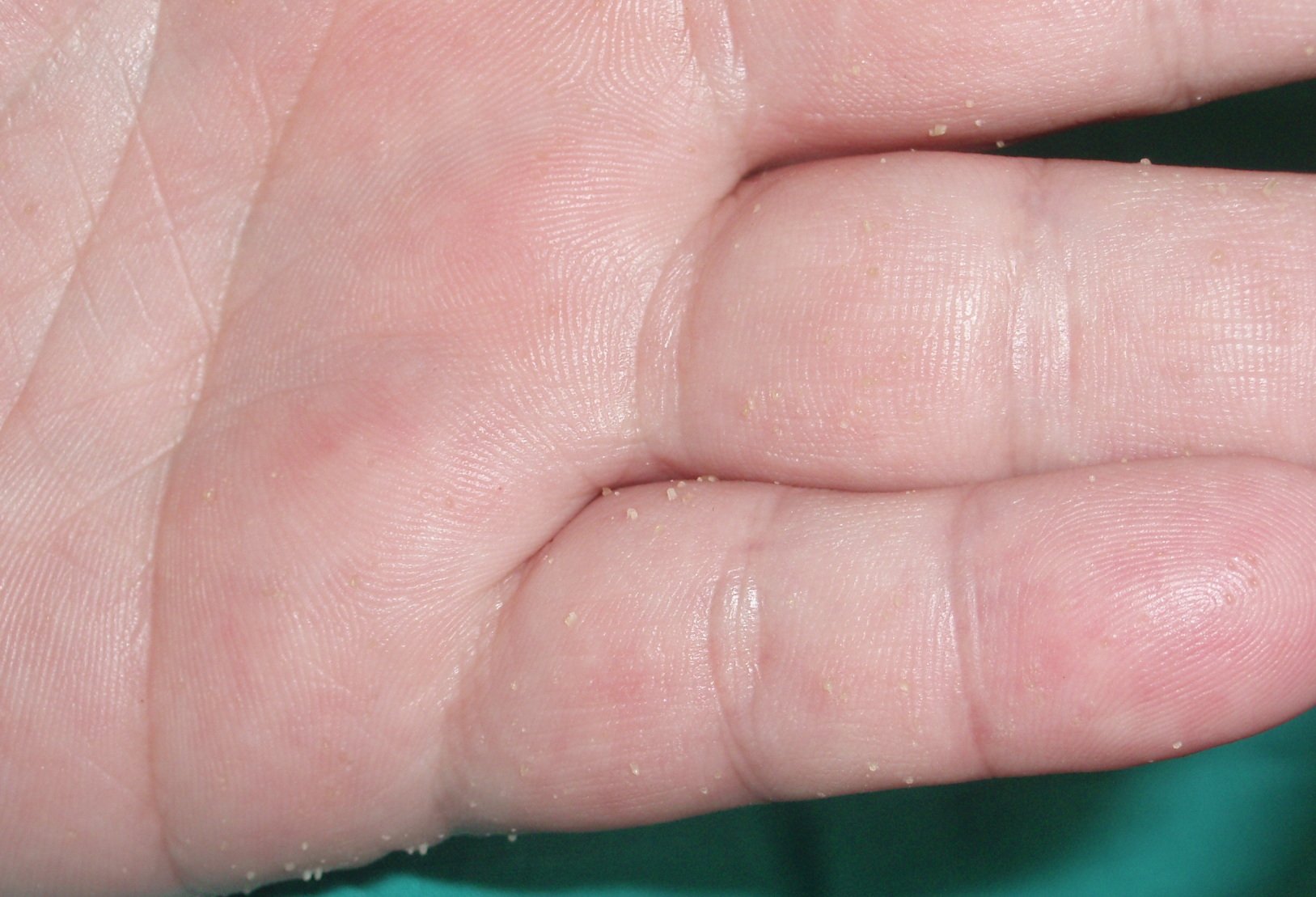 Punctate Keratosis