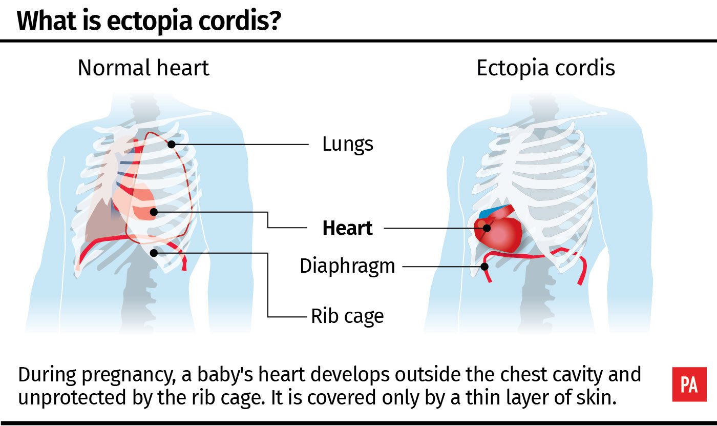 Ectopia Cordis