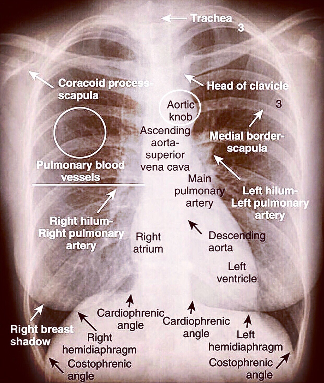 Normal Chest Xray Labeled