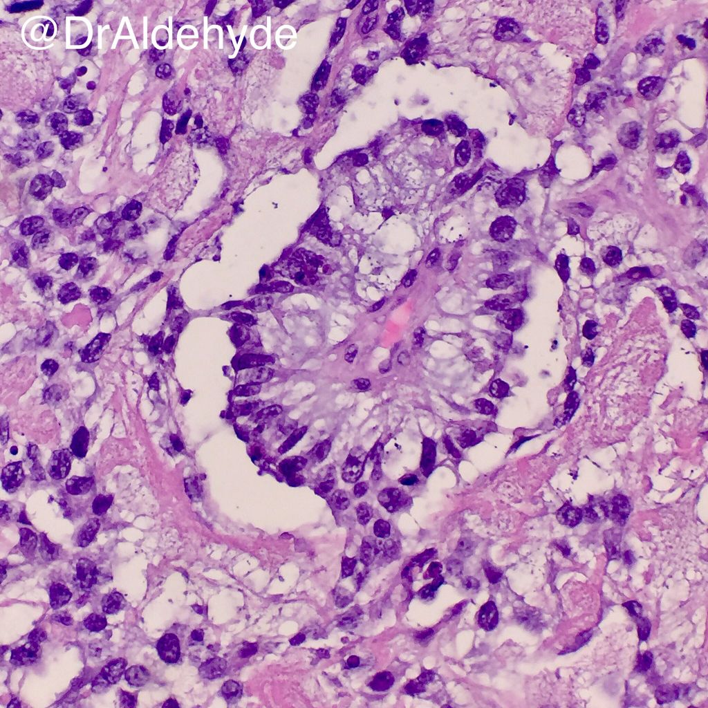 Yolk Sac Tumor Schiller Duval Bodies