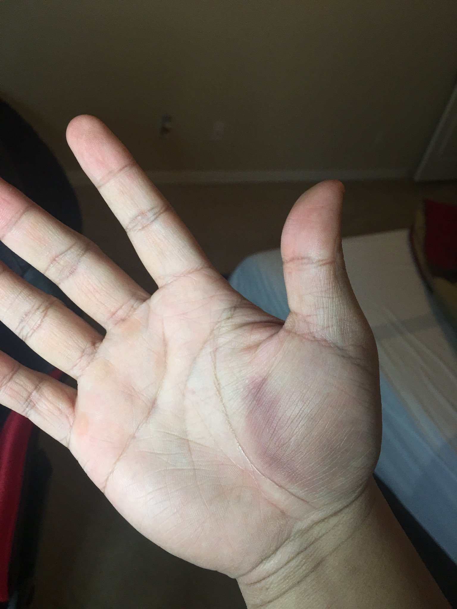 Badly Bruised Hand