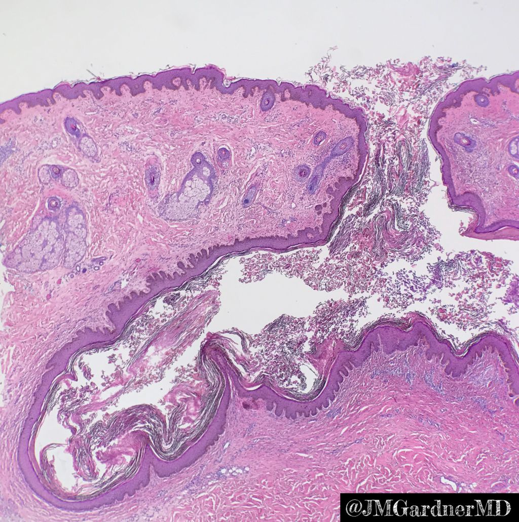 Epidermal Inclusion Cyst Histology