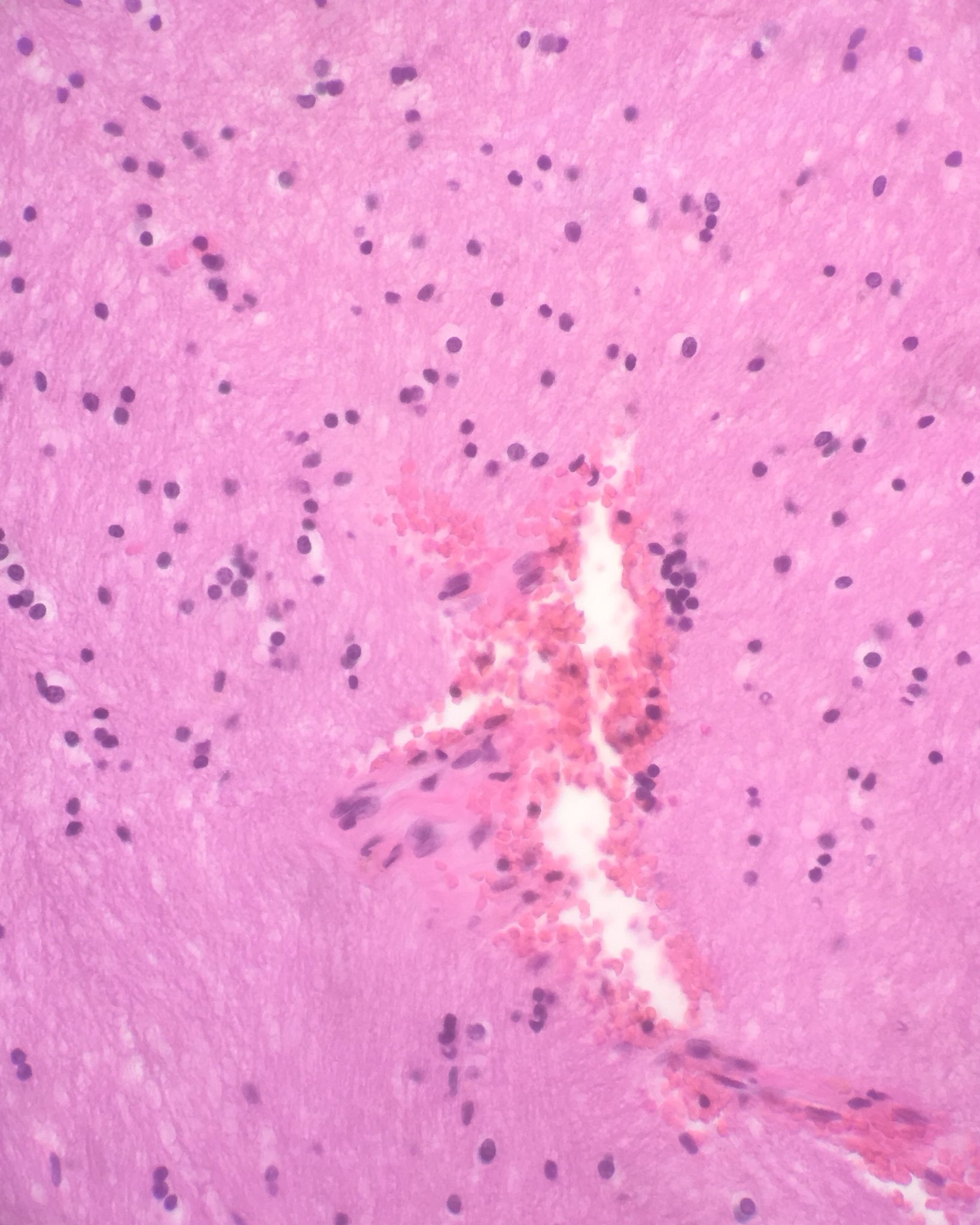 Diffuse Axonal Injury Histology