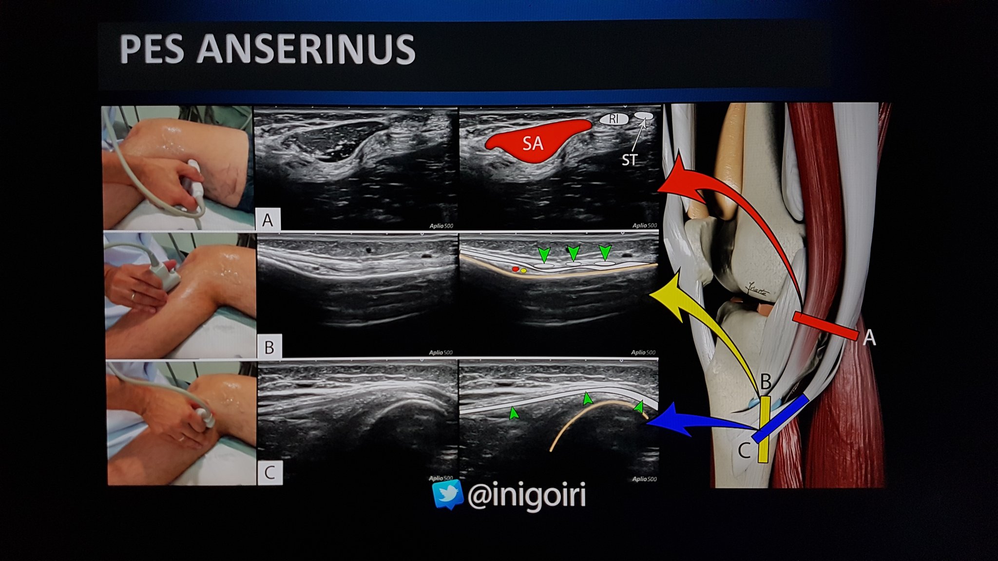 Pes Anserine Bursa Injection