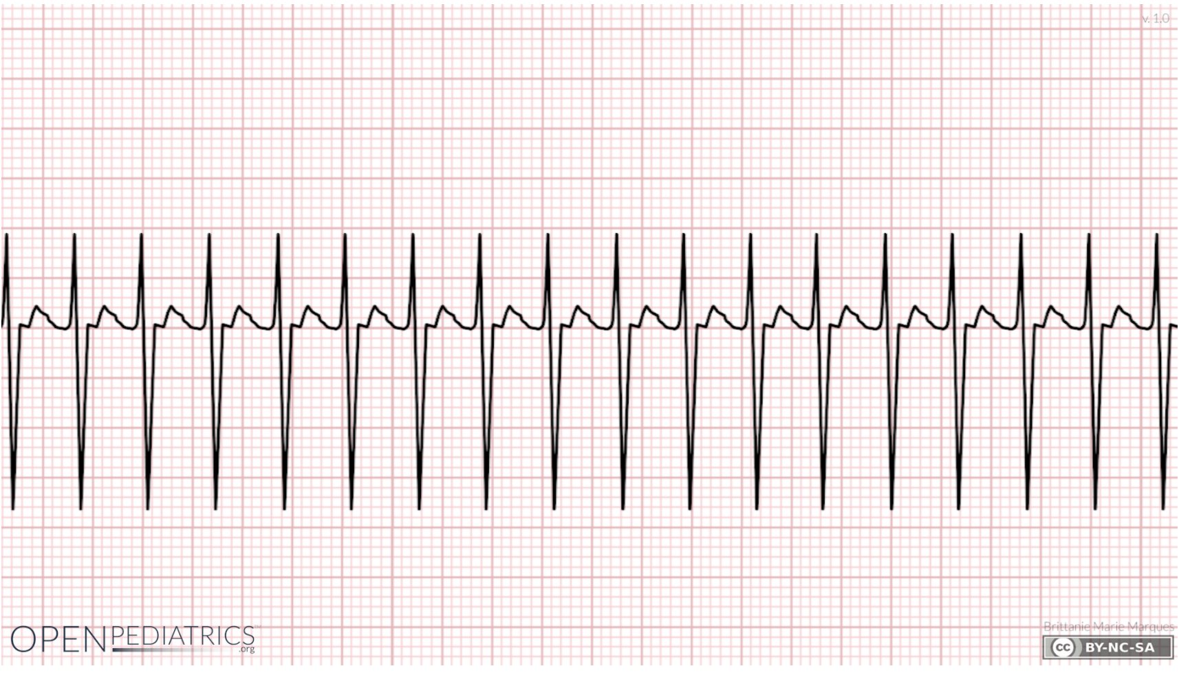 Supraventricular Tachycardia Rhythm Strip