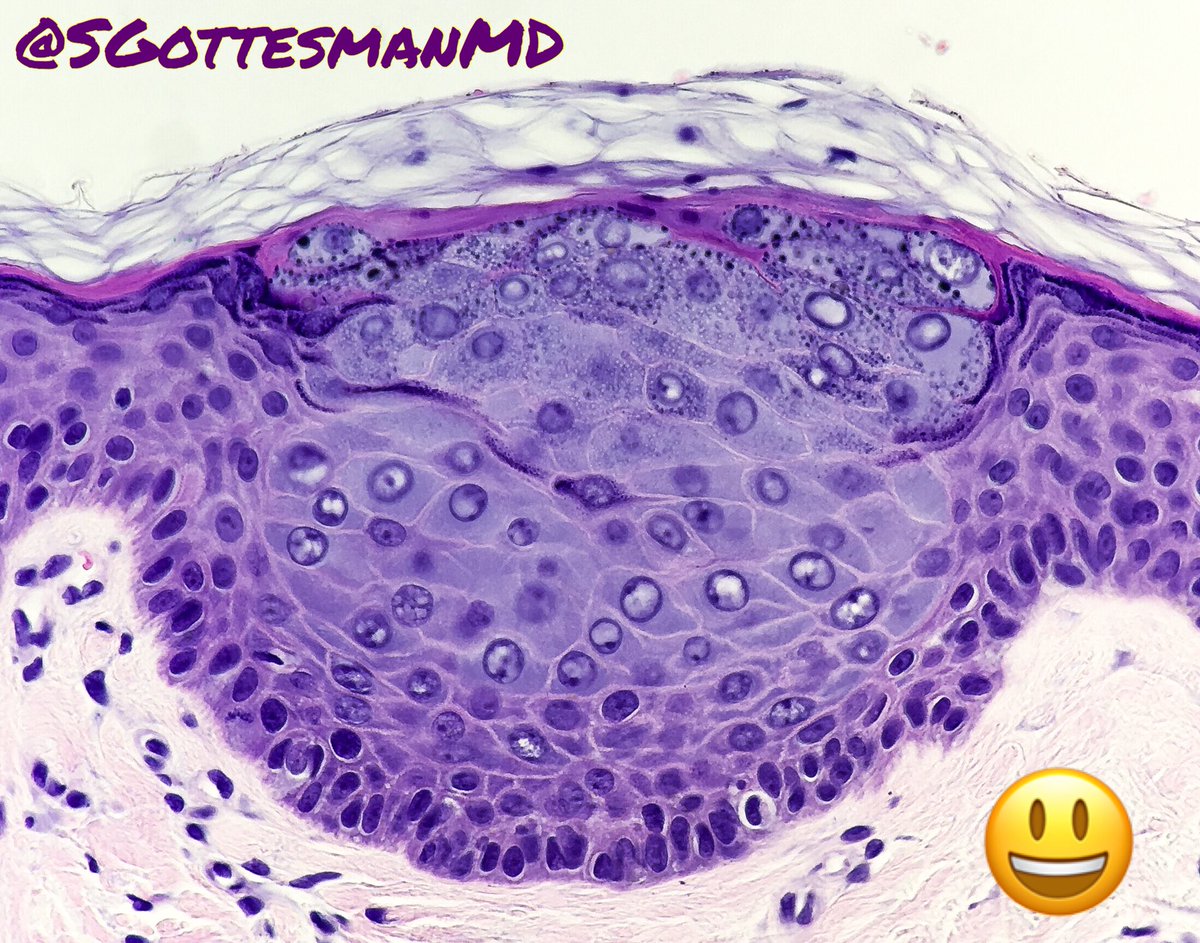 Epidermodysplasia Verruciformis Workup Laboratory Studies