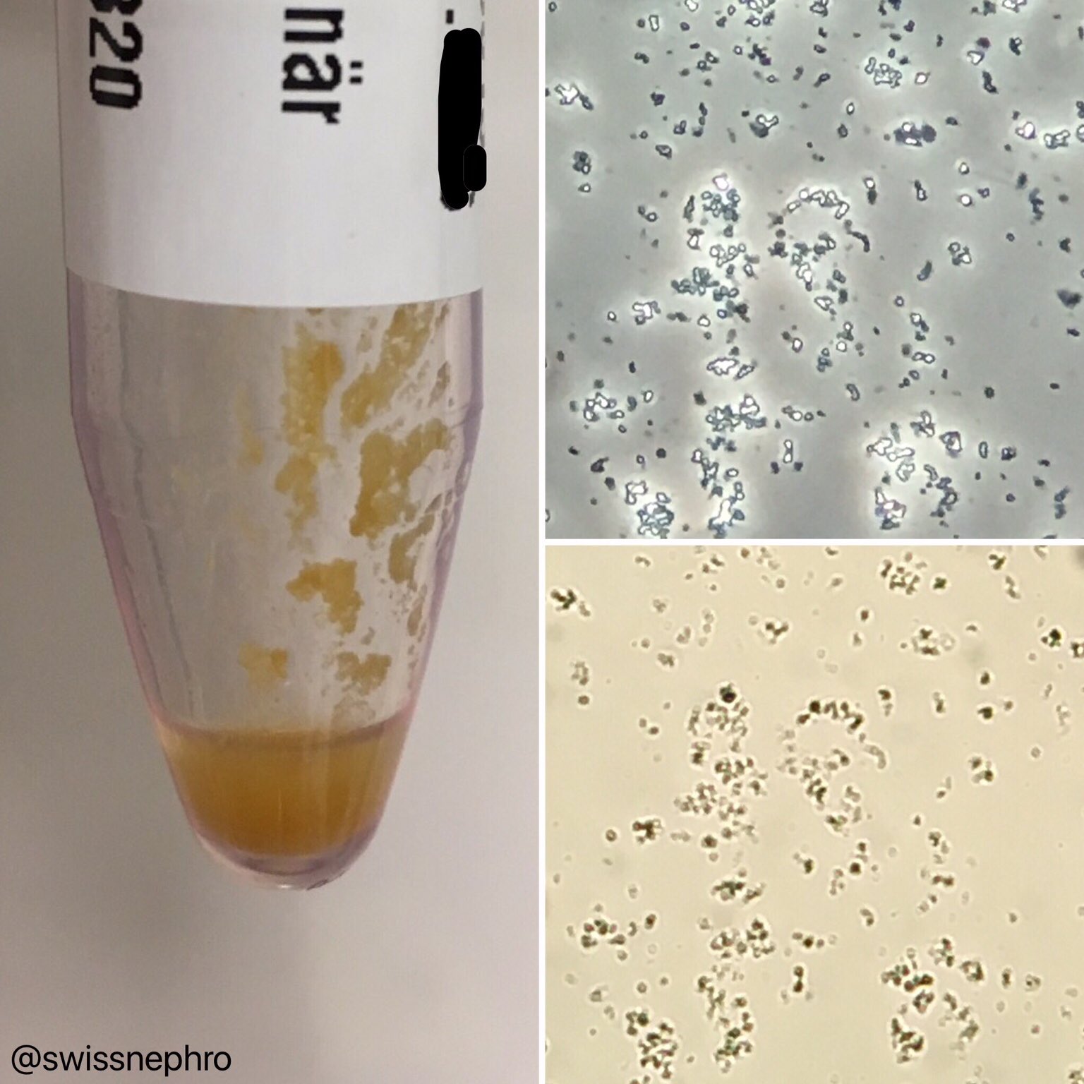 Amorphous Urates In Urine