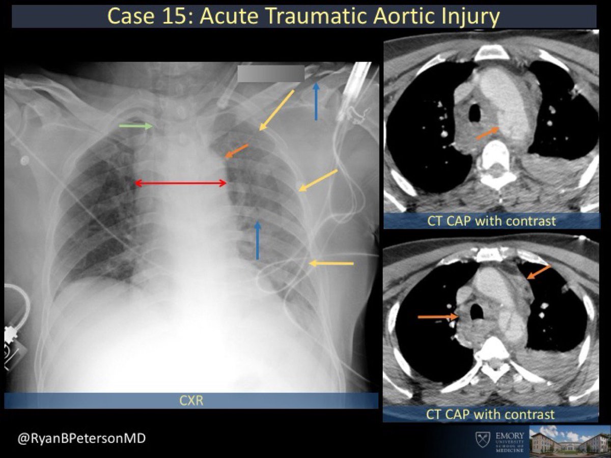 Traumatic Aortic Rupture