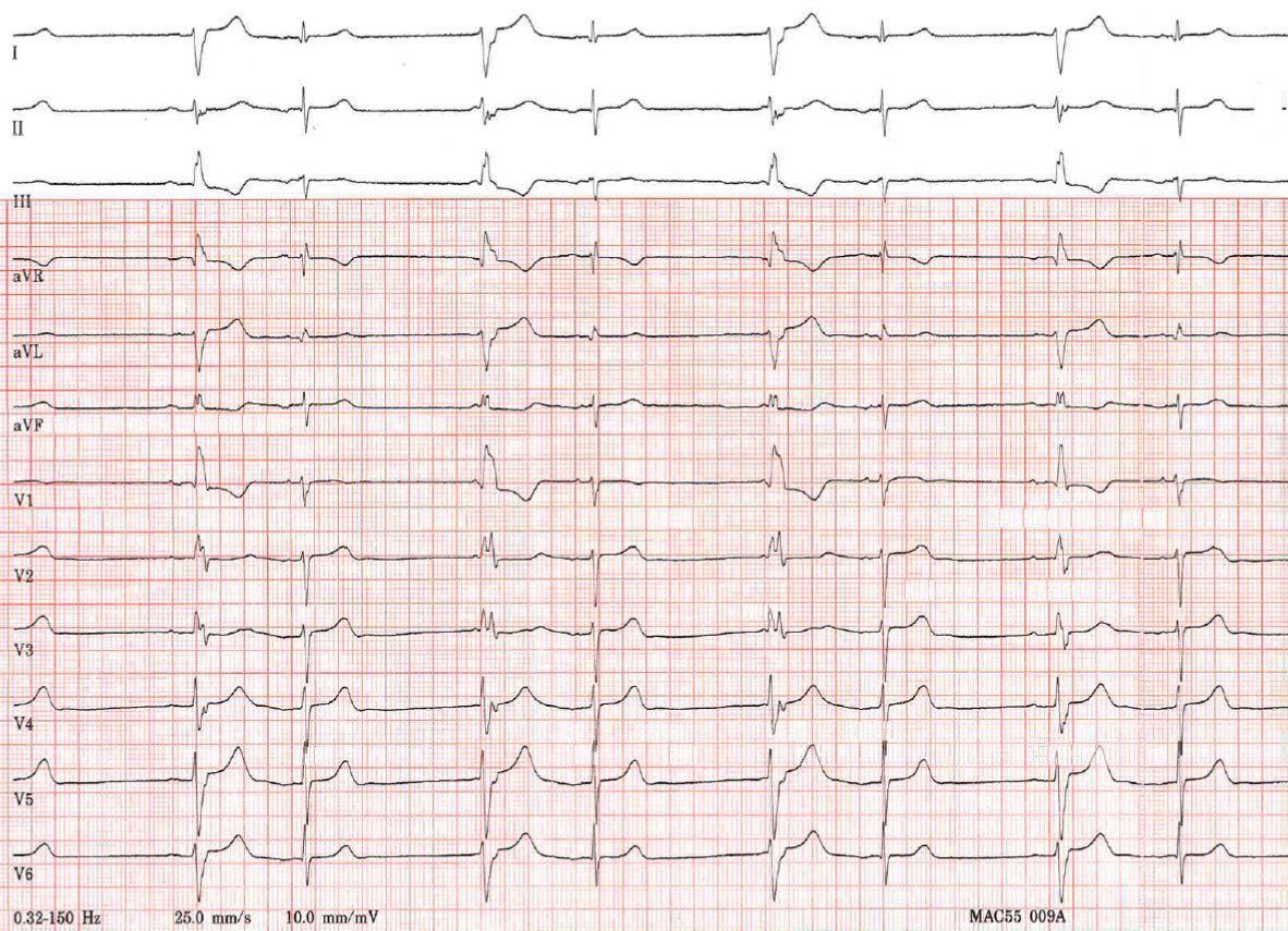 Bigeminal Rhythm Ekg