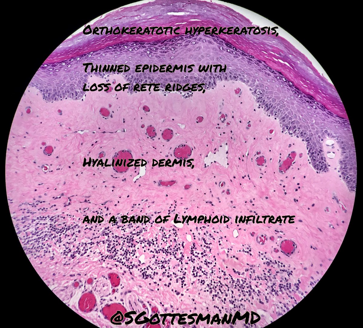 Silvija Gottesman Md On Twitter Lichen Sclerosus Et Atrophicus
