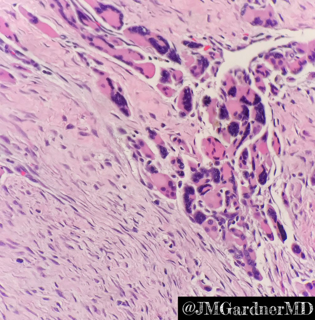 Muscle Atrophy Histology