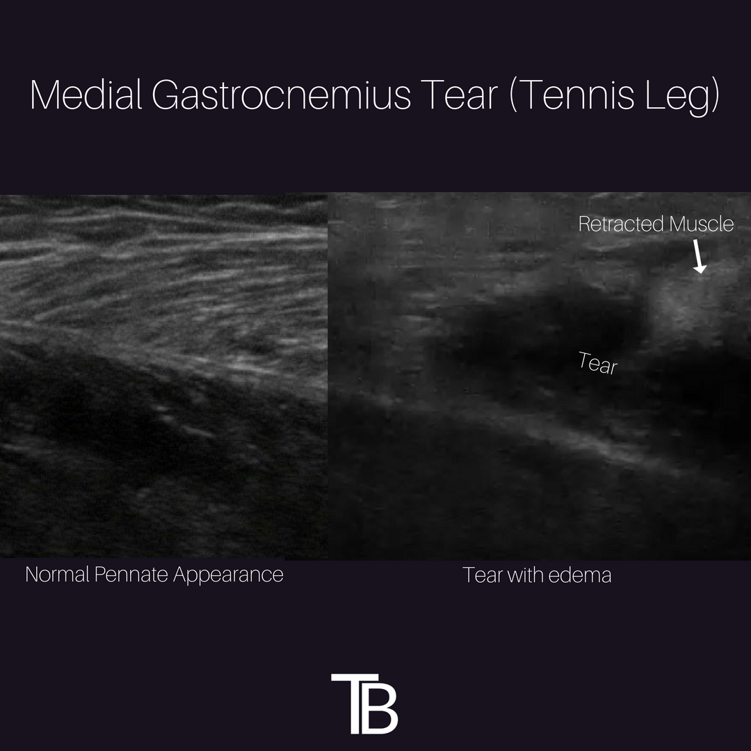 Gastrocnemius Tear Ultrasound