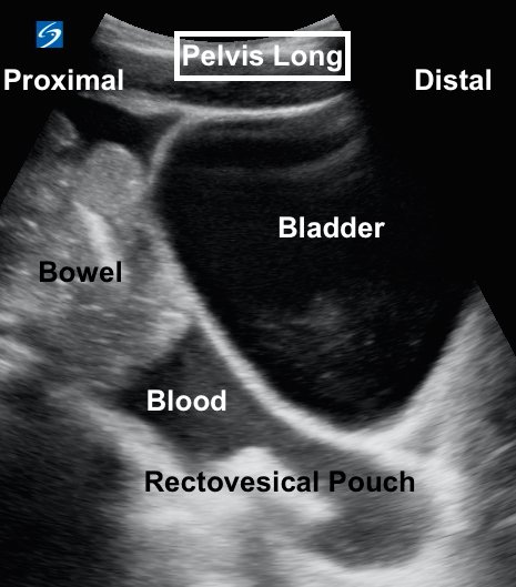 Rectouterine Pouch Ultrasound