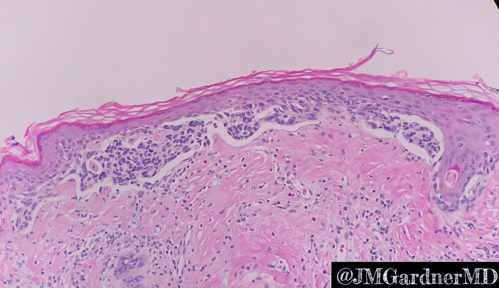 Lentigo Maligna Melanoma Histology