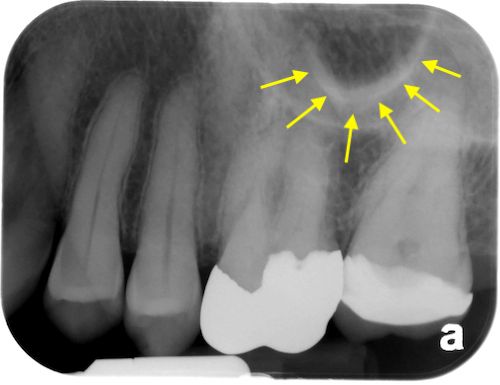 Zygomatic Bone Maxillary Process
